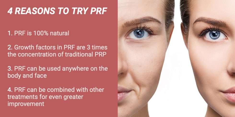 Introducing PRF - Platelet Rich Fibrin | Aestha Clinic