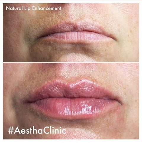 5 Most Common Lip Problems | Aestha Clinic