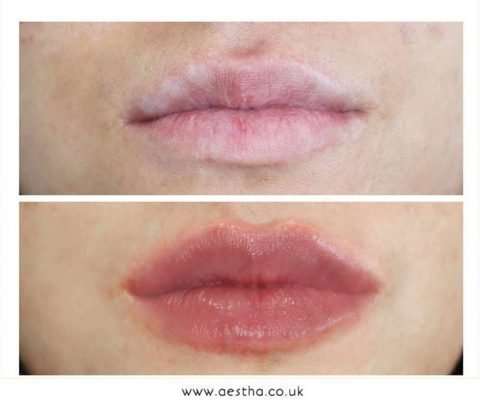 5 Most Common Lip Problems | Aestha Clinic