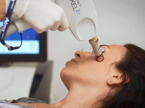 iPixel: Fractional Ablative Laser Resurfacing | Aestha Clinic