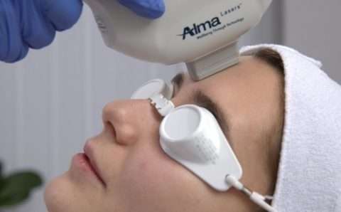 DYE: VL Laser Rosacea Treatment | Aestha Clinic