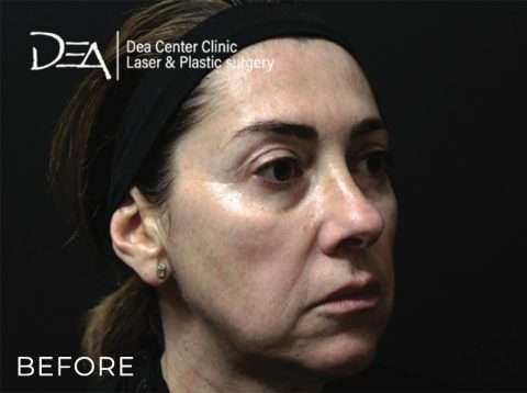 Lanluma - the Ultimate Collagen Stimulator | Aestha Clinic