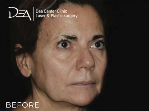 Lanluma - the Ultimate Collagen Stimulator | Aestha Clinic