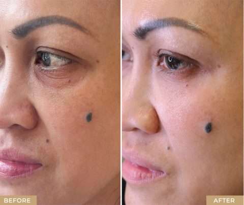 PDRN for dark circles and eye bags | Aestha Clinic