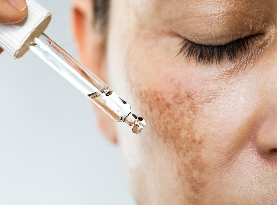 Melasma Awareness Month - Everything You Need to Know | Aestha Clinic