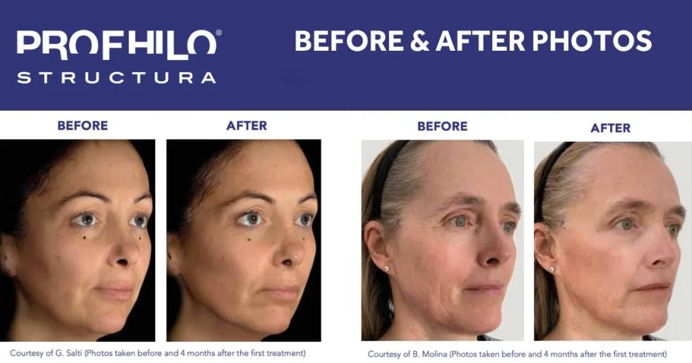 Profhilo Structura: Advanced Skin Rejuvenation | Aestha Clinic