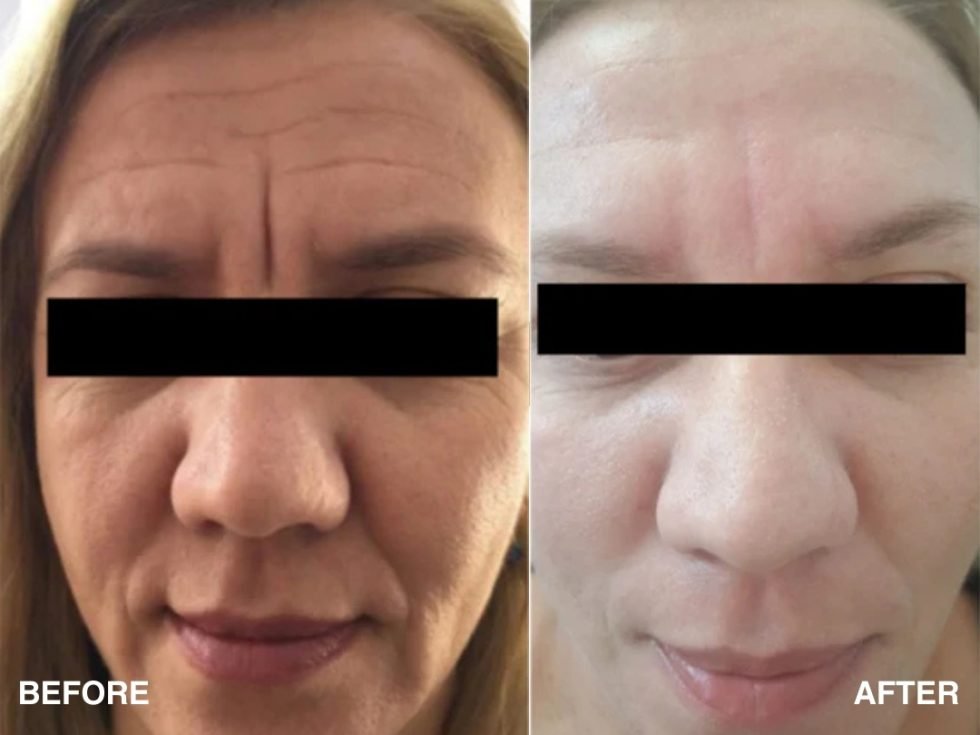 Nano Fat Transfer and Stem Cells Facelift: Advanced Facial Rejuvenation ...