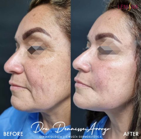 Collagen Biostimulators: Lenisna vs Juvelook | Aestha Clinic